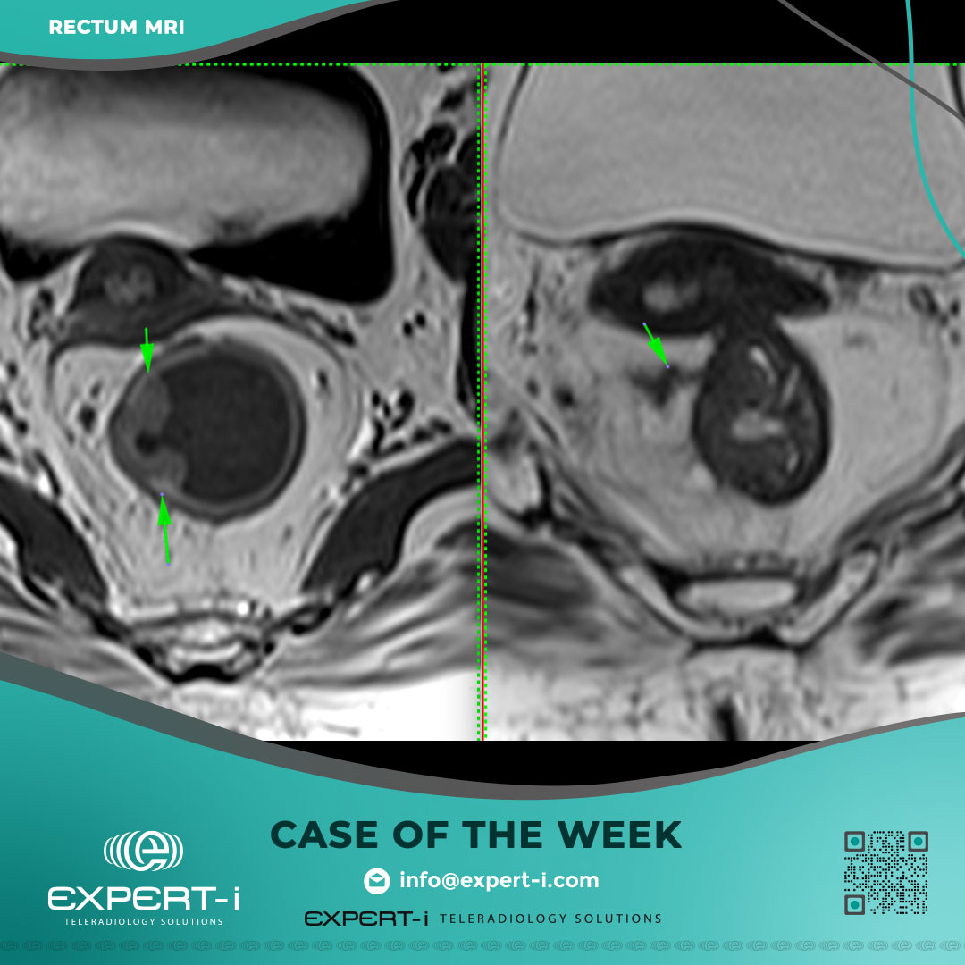Understanding MRI Staging of Rectal Cancer: T3c N2a Example - Tele ...