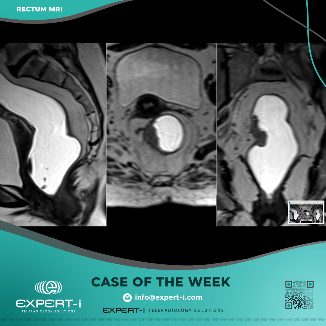 Understanding MRI Staging of Rectal Cancer: T3c N2a Example - Tele ...