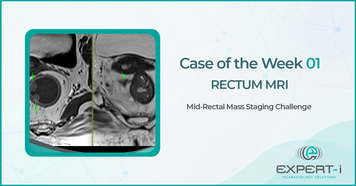 Understanding MRI Staging of Rectal Cancer: T3c N2a Example - Tele ...
